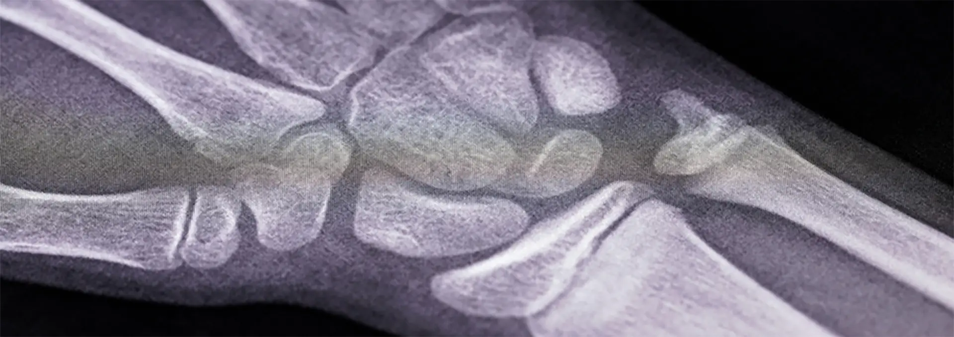 Fractura scafoid - cauze, simptome si tratament | Afectiuni tratate ...