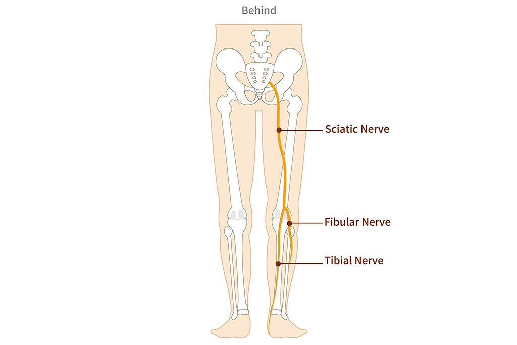 Deblocare nerv sciatic - Solutii eficiente de tratament | Kinetic.ro